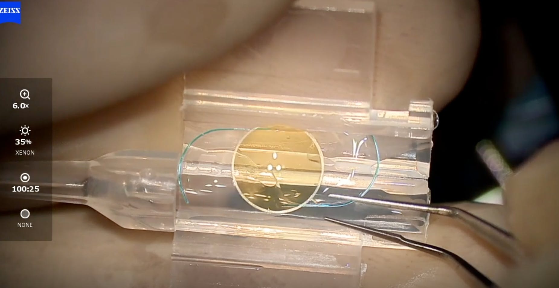 Light Adjustable Lens Loading and Implantation - Eyetube